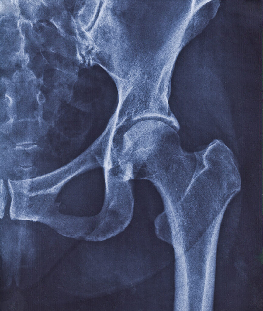 Hip Care - Orthopaedic Hospital of Wisconsin